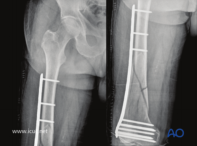 MIO - Bridge plating (LISS or LCP) for Wedge, fragmentary, distal 1/3 ...