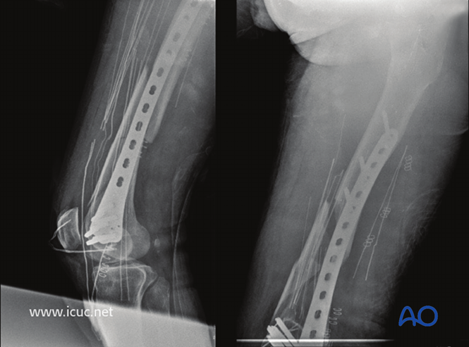 MIO - Bridge plating (LISS or LCP) for Wedge, fragmentary, distal 1/3 ...