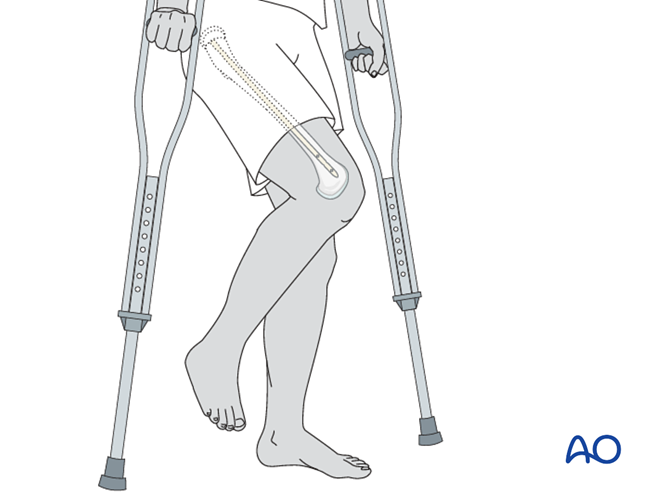Traction for Extraarticular fracture, simple