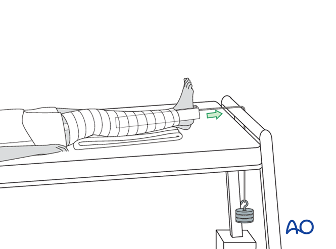 Traction for Extraarticular fracture, simple