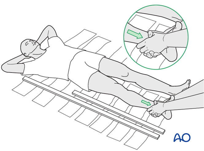 Traction for Extraarticular fracture, simple
