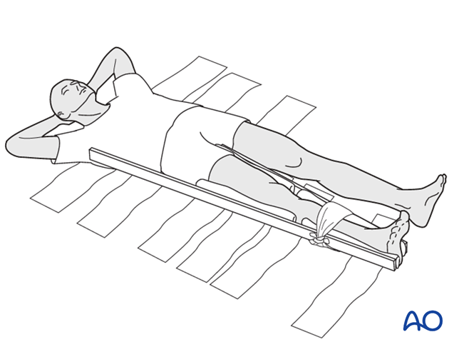 Traction for Extraarticular fracture, simple