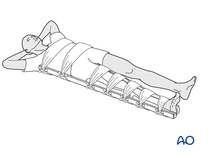 Traction for Extraarticular fracture, simple