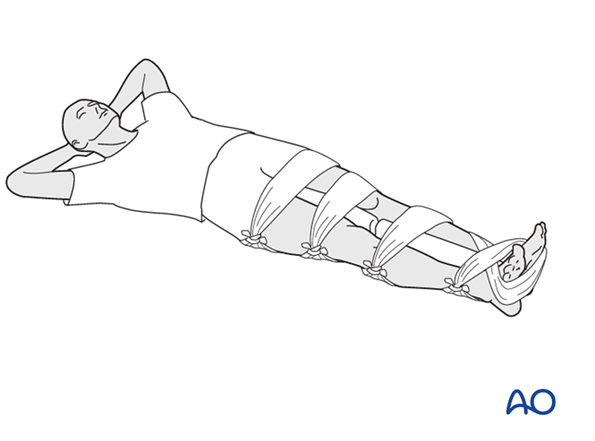 Traction for Extraarticular fracture, simple