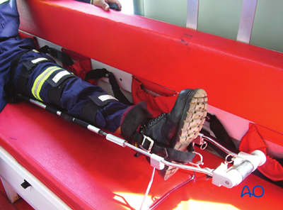 Traction for Extraarticular fracture, simple