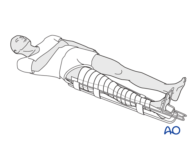 Traction for Extraarticular fracture, simple
