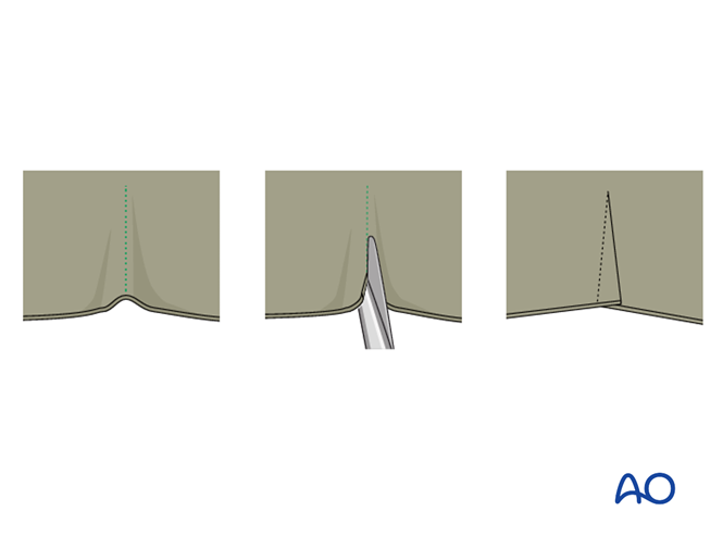 Traction for Extraarticular fracture, simple