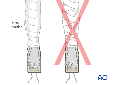 Traction for Extraarticular fracture, simple