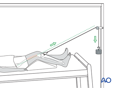 Traction for Extraarticular fracture, simple