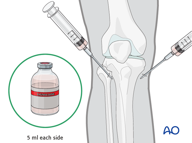 Traction for Extraarticular fracture, simple
