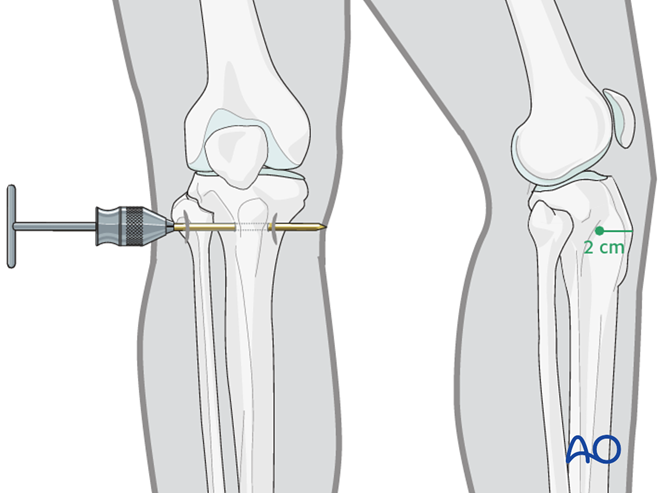 Traction for Extraarticular fracture, simple