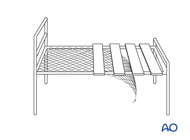 Traction for Extraarticular fracture, simple
