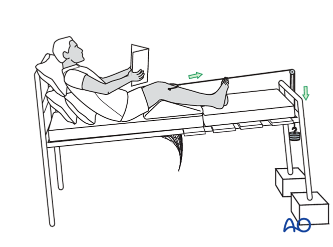Traction for Extraarticular fracture, simple