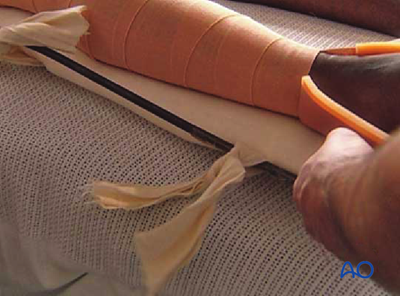 Temporary Thomas splint for Simple, transverse, proximal 1/3 fractures