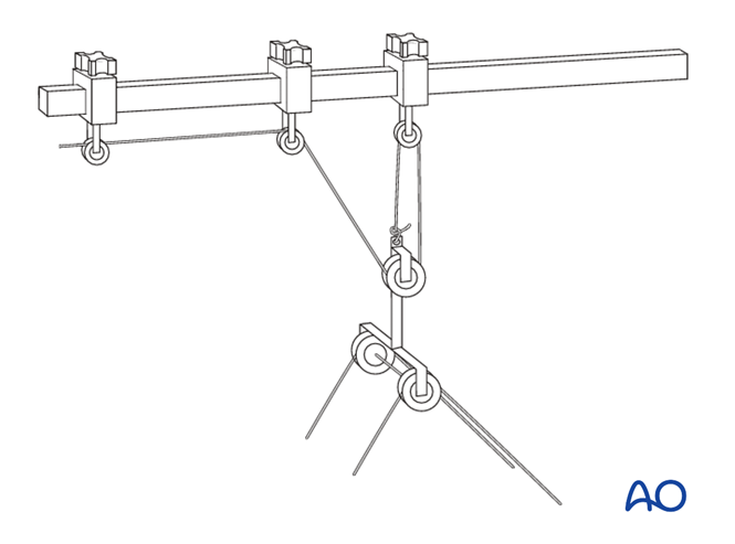 Temporary Thomas splint for Simple, transverse, proximal 1/3 fractures