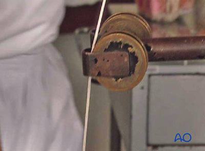 Temporary Thomas splint for Simple, spiral, proximal 1/3 fractures