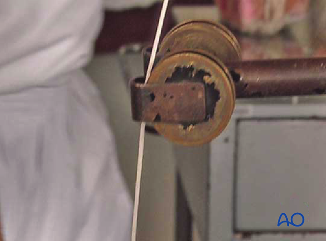 Temporary Thomas splint for Simple, spiral, proximal 1/3 fractures