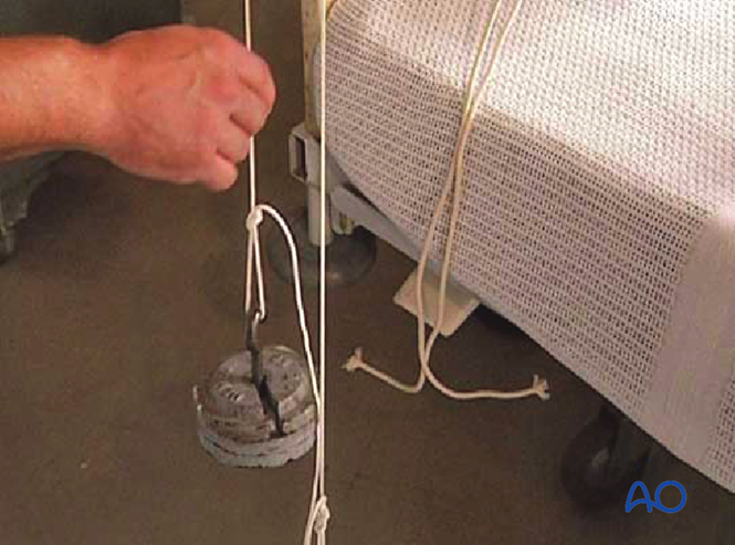 Temporary Thomas splint for Simple, transverse, proximal 1/3 fractures