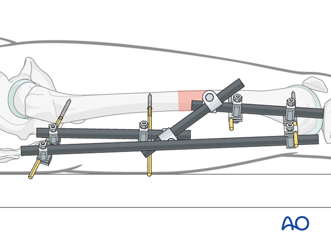 Temporary external fixator for Simple, transverse, distal 1/3 fractures