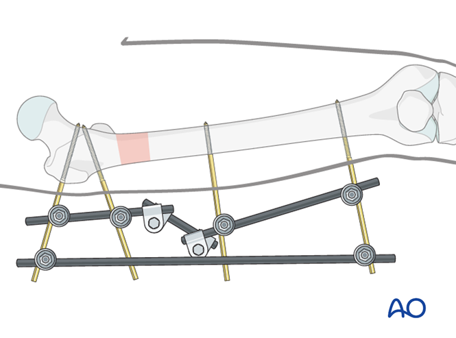 Temporary external fixation for Simple, spiral, proximal 1/3 fractures