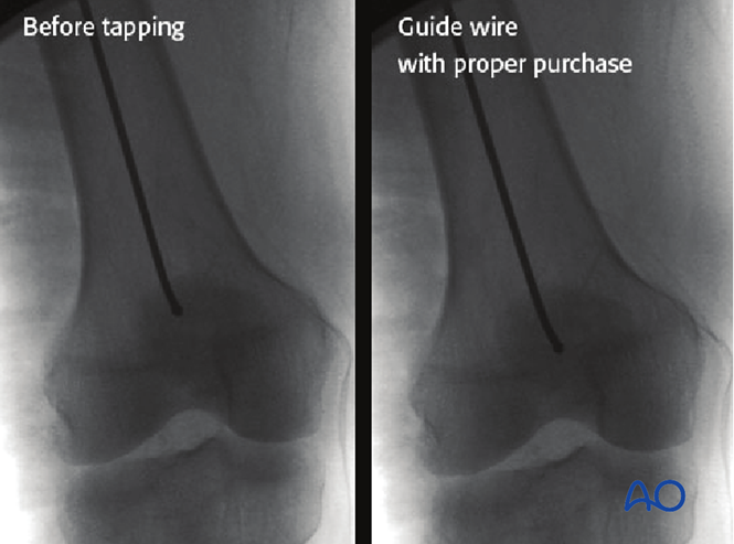 Antegrade nailing for Segmental, intact, proximal 1/3 fractures