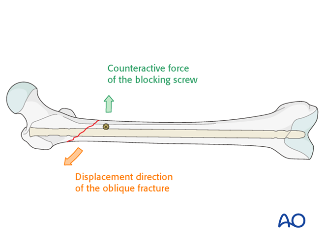 Antegrade nailing for Segmental, intact, proximal 1/3 fractures