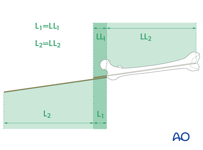 Antegrade nailing for Segmental, intact, proximal 1/3 fractures