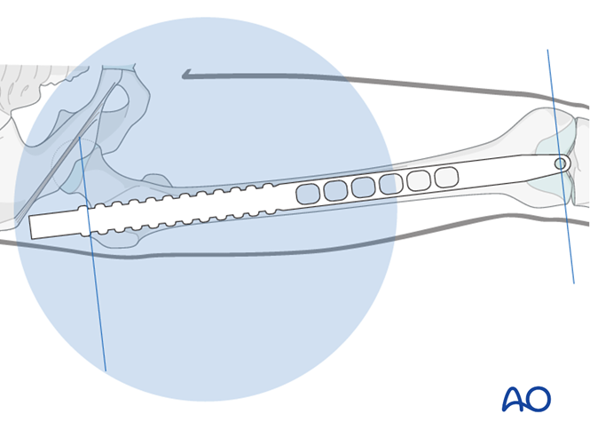 Antegrade nailing for Segmental, fragmentary, proximal 1/3 fractures