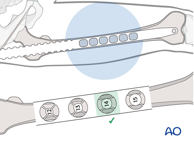 Antegrade nailing for Segmental, fragmentary, proximal 1/3 fractures