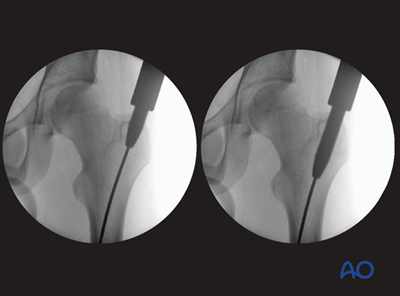 Antegrade nailing for Segmental, fragmentary, proximal 1/3 fractures