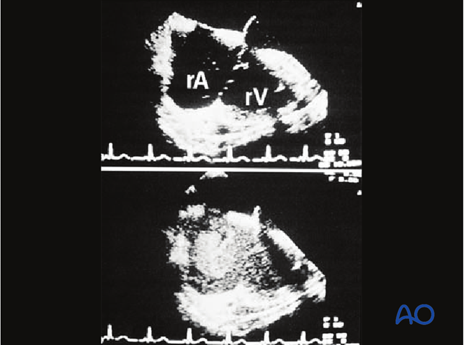 Antegrade nailing for Segmental, fragmentary, proximal 1/3 fractures