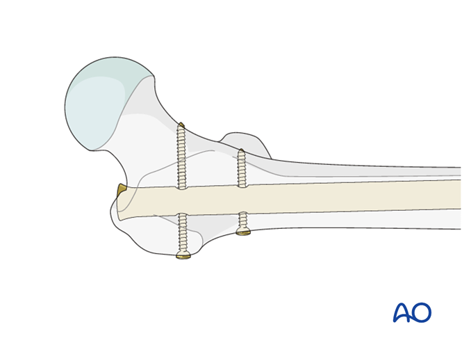 Antegrade nailing for Simple, oblique, middle 1/3 fractures