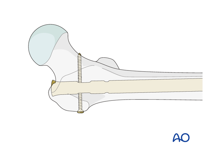 Antegrade nailing for Simple, transverse, middle 1/3 fractures