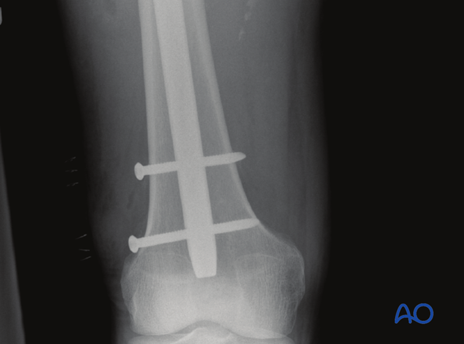 Antegrade nailing for Segmental, intact, proximal 1/3 fractures