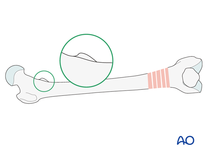 Retrograde nailing for Simple, transverse, distal 1/3 fractures