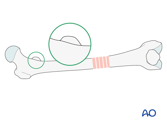Antegrade nailing for Simple, oblique, middle 1/3 fractures