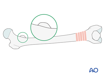 Retrograde nailing for Simple, transverse, distal 1/3 fractures
