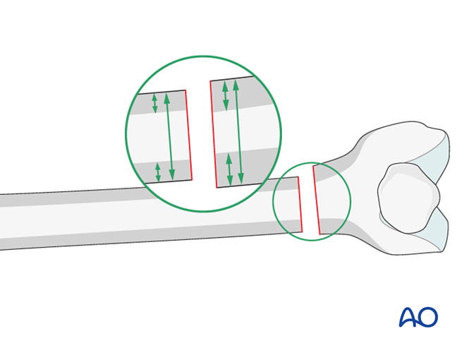 Retrograde nailing for Simple, transverse, distal 1/3 fractures