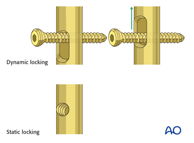 Antegrade nailing for Simple, spiral, proximal 1/3 fractures