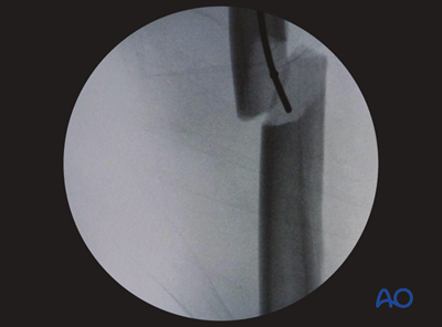 Antegrade nailing for Simple, transverse, middle 1/3 fractures