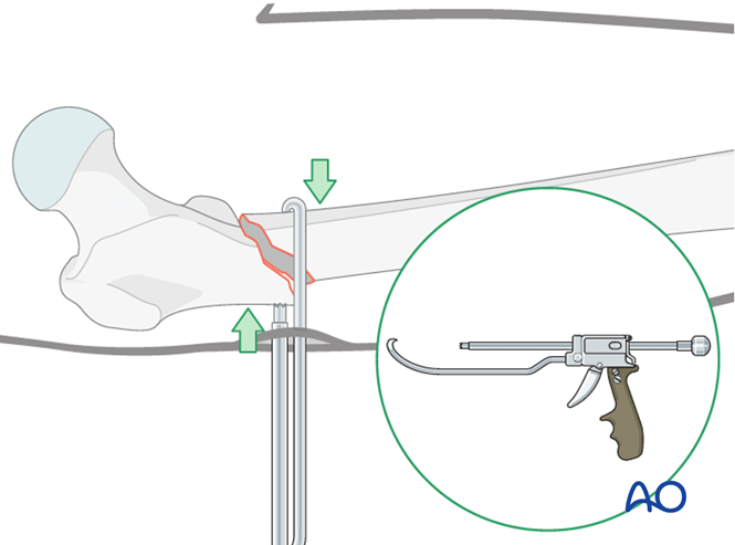 Antegrade nailing for Simple, spiral, proximal 1/3 fractures