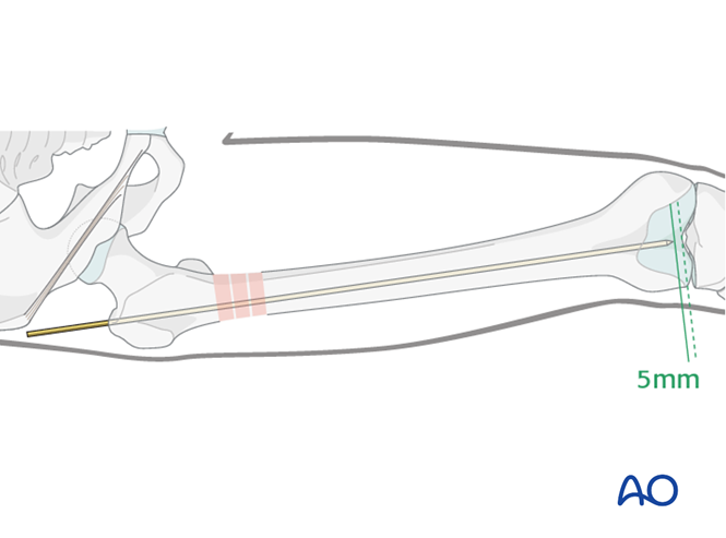 Antegrade nailing for Segmental, fragmentary, proximal 1/3 fractures