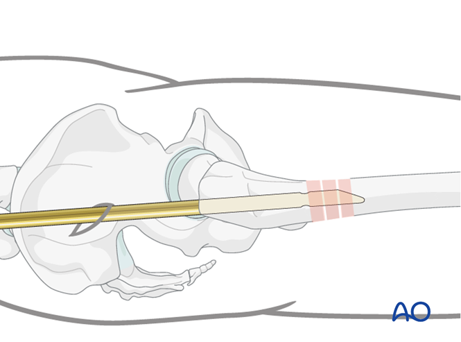 Antegrade nailing for Segmental, fragmentary, proximal 1/3 fractures
