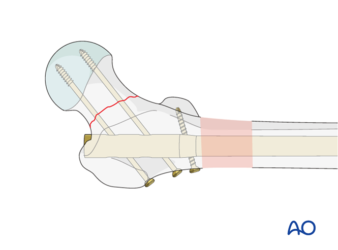 Antegrade nailing for Segmental, fragmentary, proximal 1/3 fractures