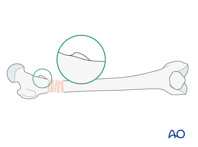 Antegrade nailing for Segmental, intact, proximal 1/3 fractures