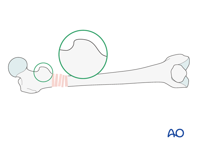 Antegrade nailing for Segmental, intact, proximal 1/3 fractures