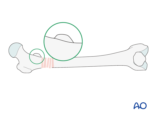 Antegrade nailing for Segmental, intact, proximal 1/3 fractures