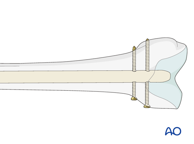 Antegrade nailing for Segmental, intact, proximal 1/3 fractures