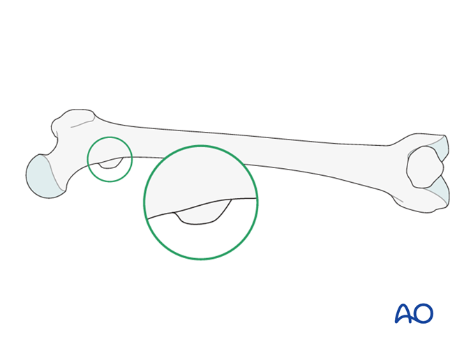 Antegrade nailing for Segmental, intact, proximal 1/3 fractures