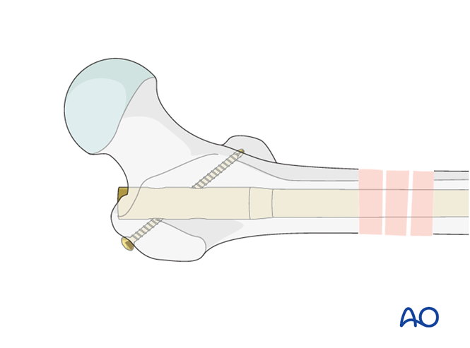 Antegrade nailing for Segmental, intact, proximal 1/3 fractures